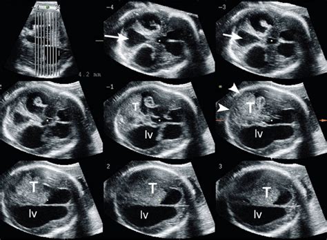 Tomographic Ultrasound Imaging Carcinoma Of The Right Choroid Download Scientific Diagram