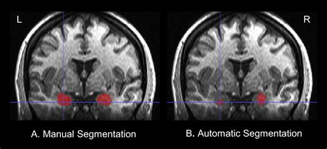 A Comprehensive Protocol For Manual Segmentation Of The Medial Temporal