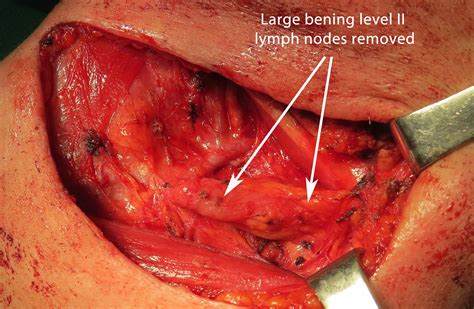 Marginal Mandibular Nerve Weakness Ramus Mandibularis Level I Neck
