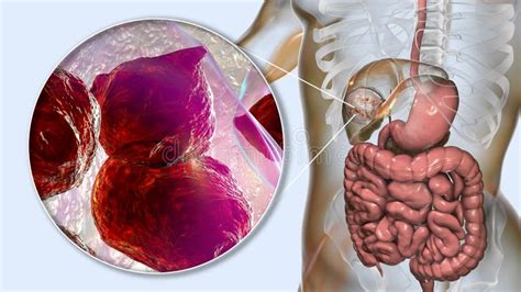 Hydatid Cyst Of Echinococcus Granulosus In The Liver Stock Illustration