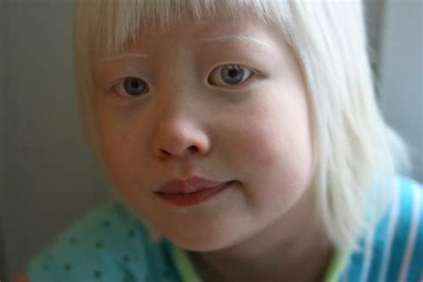 Types Of Albinism Albinism