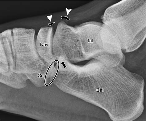 Chopart Fracture Dislocation Radiology Reference Article The Best