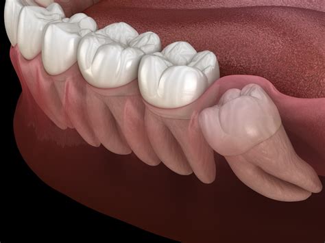 When Do Wisdom Teeth Come In Wilkinson Dental