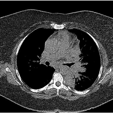 Axial Ct Scan Of The Chest Without Constrast Demonstrating Infiltrative