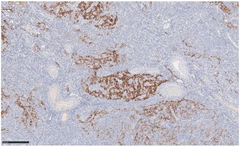 Uterine Tumors Resembling Ovarian Sex Cord Tumors Utroscts Case Report And Narrative Review
