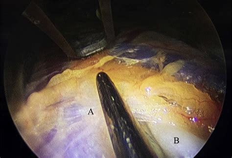 Endoscopic View Of Proximal Median Nerve Decompression With Tenotomy