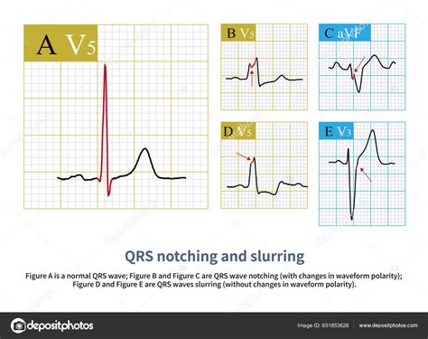 Normal Ventricular Depolarization Produces Smooth Sharp Qrs Waves Local