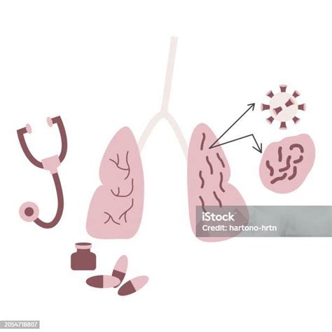 폐암 질환 벡터 일러스트 레이 션 에서 에서 플랫 스타일 와 암 질병 주제 와 편집 가능한 벡터 그림입니다 개념에 대한 스톡 벡터 아트 및 기타 이미지 Istock
