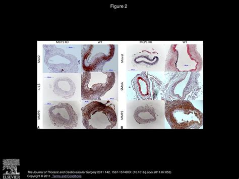 Bone Marrowderived MCP1 Required For Experimental Aortic Aneurysm