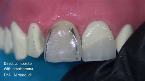 Direct Composite With Omnichroma Youtube