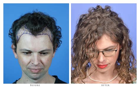 Transgender Woman Before And After
