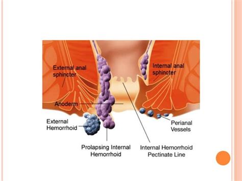 Haemorrhoids Pptx
