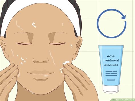 How To Remove Whiteheads