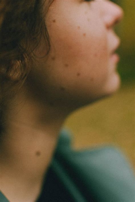 When Should You Be Concerned About Moles