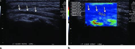 Normal Ulnar Nerve In The Cubital Tunnel In An Asymptomatic 58 Year Old