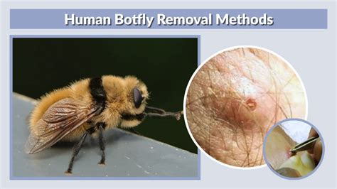 Human Botfly Infestation Symptoms Removal And Prevention