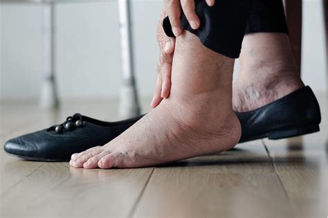Leg Swelling Before Period At Jessica Rice Blog