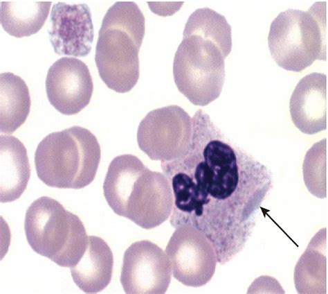 Nonmalignant Leukocyte Disorders Rodaks Hematology Clinical