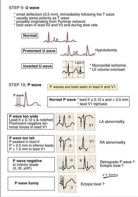 Ecg Interpretation Characteristics Of The Normal Ecg P Wave Qrs Complex St Segment T Wave Artofit