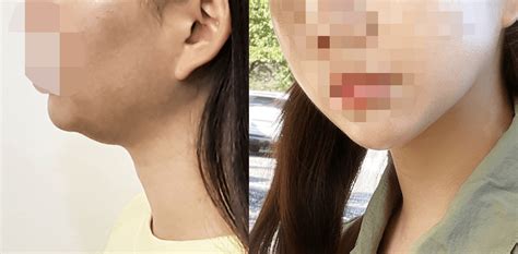파워v지방흡입v라인전체코르셋이중턱근육묶기 닥터정리반 닥터정 리반의원