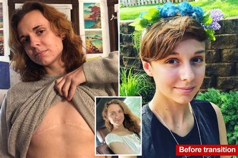Woman Who Transitioned At 16 Sues Doctors Over Double Mastectomy