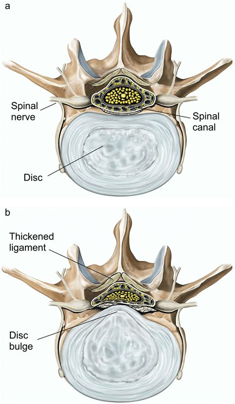 Laminectomy Decompression