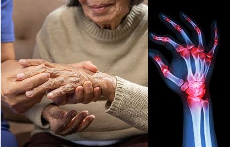 What Is Rheumatoid Arthritis Diagnosis And Tests Explained