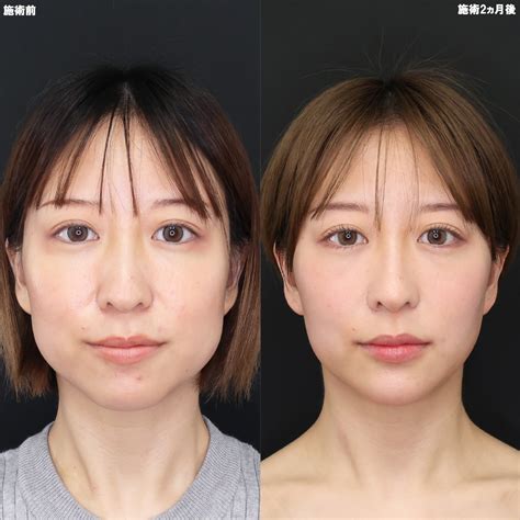 【糸リフト×バッカルファット除去】dr奥津の究極の小顔術｜症例写真・ビフォーアフター｜美容整形･美容外科のtaクリニックグループ