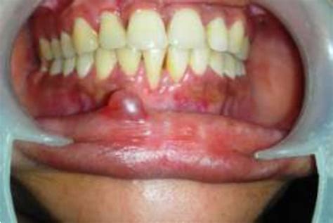 Pdf Treatment Of Lower Lip Mucocele With Diode Laser A Novel Approach Semantic Scholar