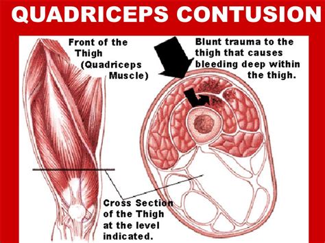 Muscle Tear Bruising Muscle Contusion Bruise Orthoinfo