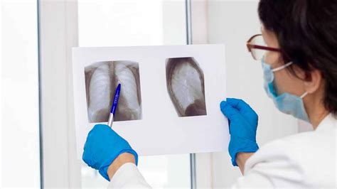 Importance Of Genetic Testing Lung Cancer Onlymyhealth