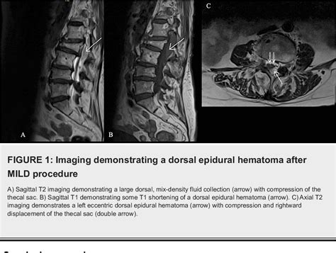 Figure 1 From Lumbar Epidural Hematoma As A Rare Complication From