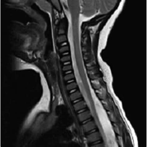 Sagittal T2 Weighted Mri Reveals Diffuse Edema And Abnormal Signal