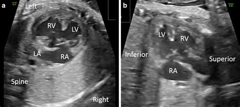 Two Dimensional Fetal Echocardiography At 30 Weeks Of Gestation A The