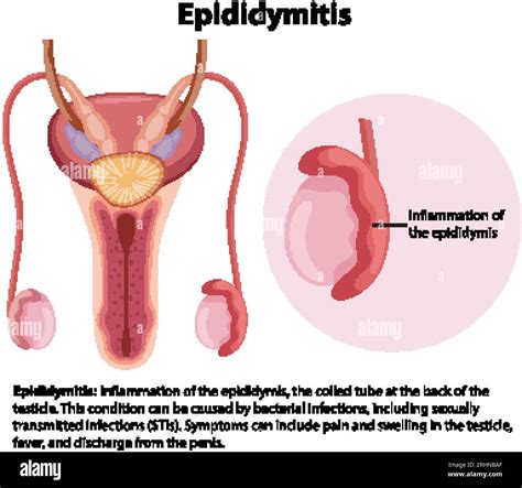 Cartoon Style Infographic Depicting Male Epididymis And Testis Anatomy