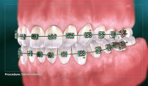 Ortho Correction Mgm Dental Tvm