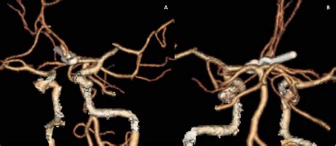 A B 3d Ct Angiography That Was Reformatted Postoperatively Showing