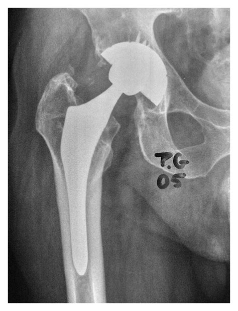 X Ray Image Of Patient With Follow Up At 12 Y Osteolysis In Acetabulum