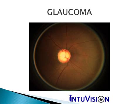 Sample Retinal Images Ppt