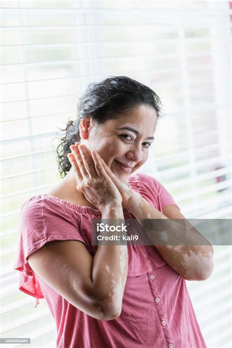 성숙한 혼합 인종 여자 와 Vitiligo 백반증에 대한 스톡 사진 및 기타 이미지 백반증 세로 구도 40 44세