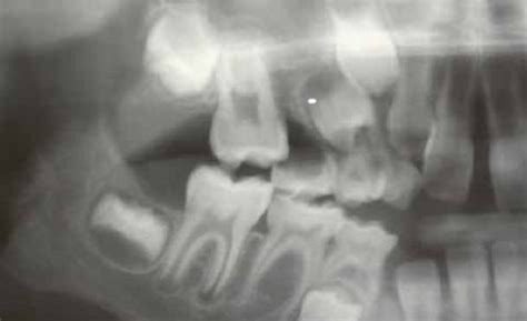 A Severely Resorbed Upper Right Second Primary Molar Download