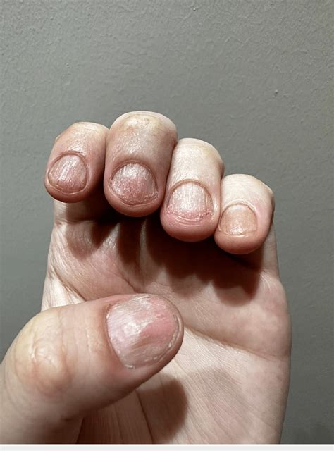 Dystrophic Fingernails With Regular Superficial Pitting And Nail