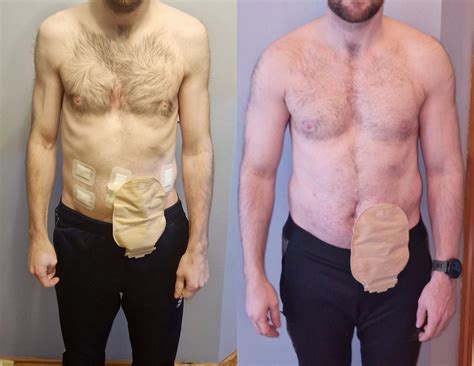4 Month Post Colostomy R Ostomy