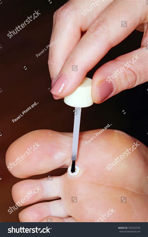 Salicylic Acid Warts