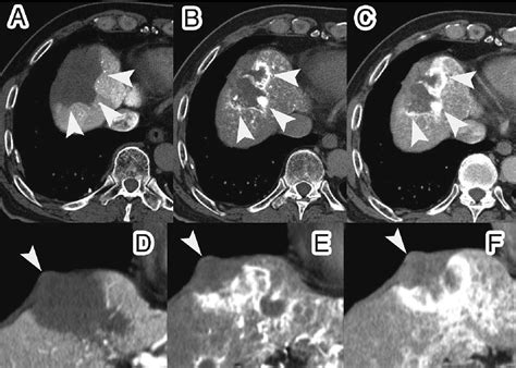 Figure 1 From A Case Of Recurrent Intraphepatic Cholangicarcinoma With