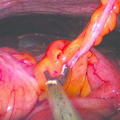 Appendix Divided From The Mesoappendix By Using Ultrasonic Ace Usual