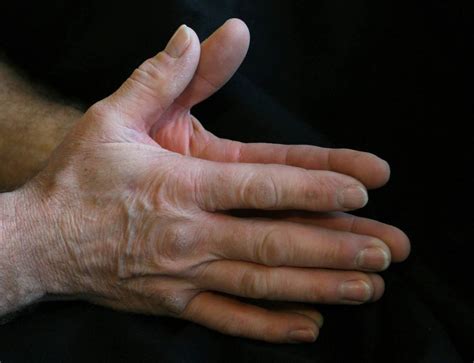 Tendinitis In The Hands And Wrists Causes Symptoms And Effective