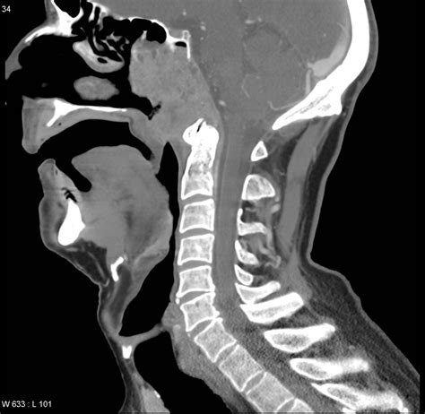 Maligni Tumori Nazofarinksa Simptomi