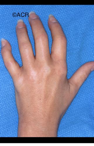 Systemic Sclerosis Flashcards Quizlet