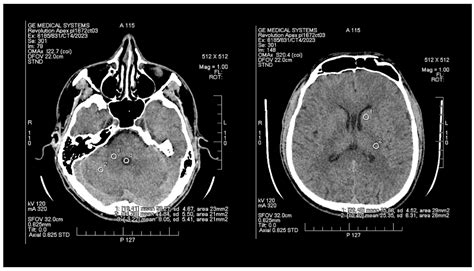 Image Quality Improvement In Deep Learning Image Reconstruction Of Head Computed Tomography